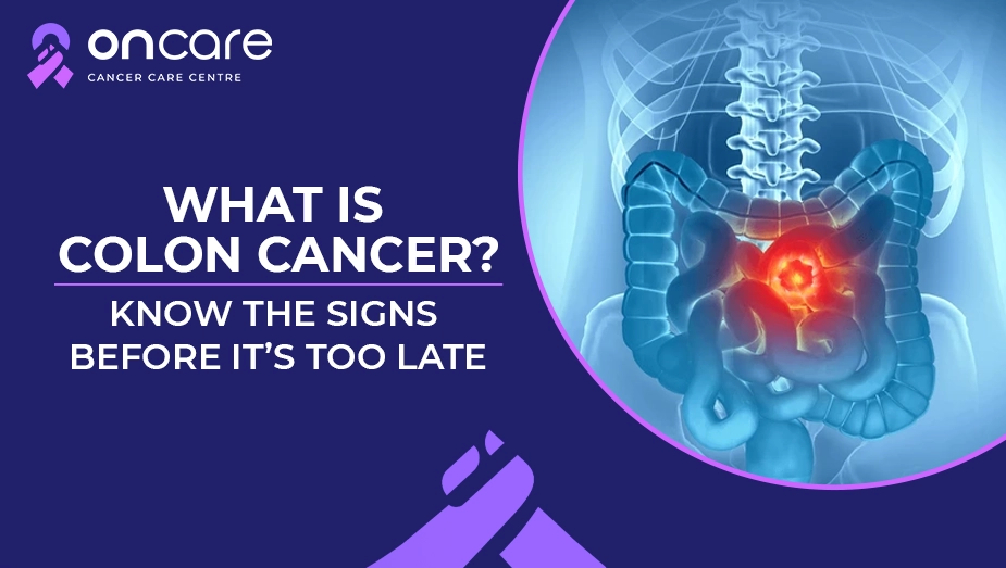 What Is Colon Cancer? Symptoms, Causes, Risks & Early Detection