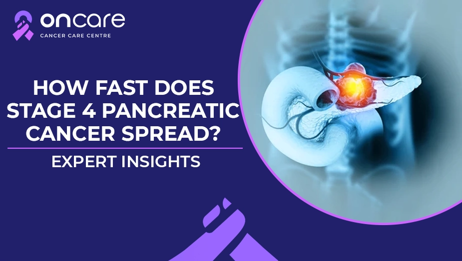 Stage 4 Pancreatic Cancer: How Fast It Spreads & Symptoms