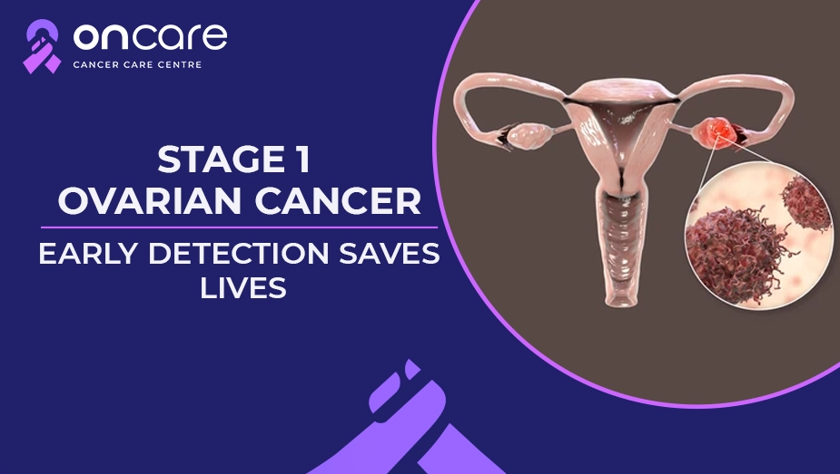 Why does early detection matters in stage 1 ovarian cancer?