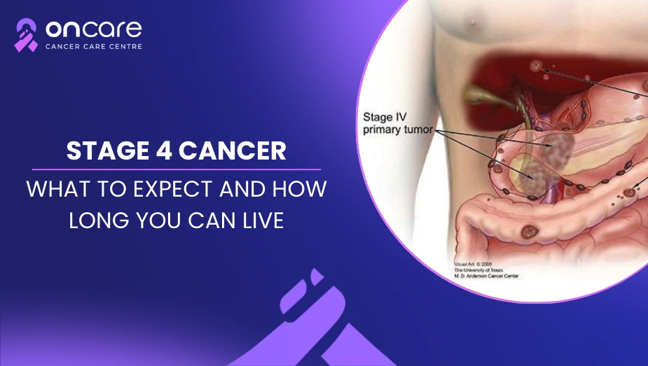 What Is Stage 4 Cancer? Meaning, Risks and Care | Oncare