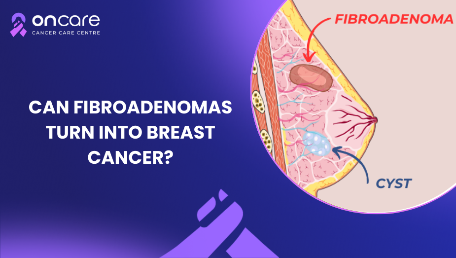 Can Fibroadenomas Turn Into Breast Cancer? Explained | Oncare