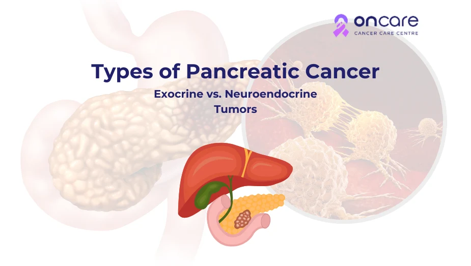 Stage 4 Pancreatic Cancer Symptoms: Key Signs and What to Expect