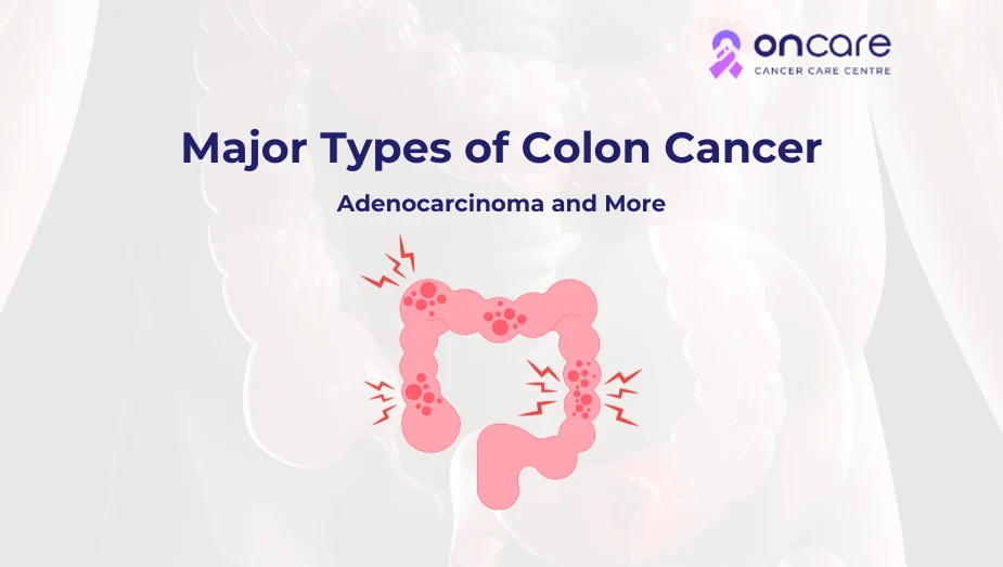 Low Cost Cancer Treatment in India | Expert Care at OnCare