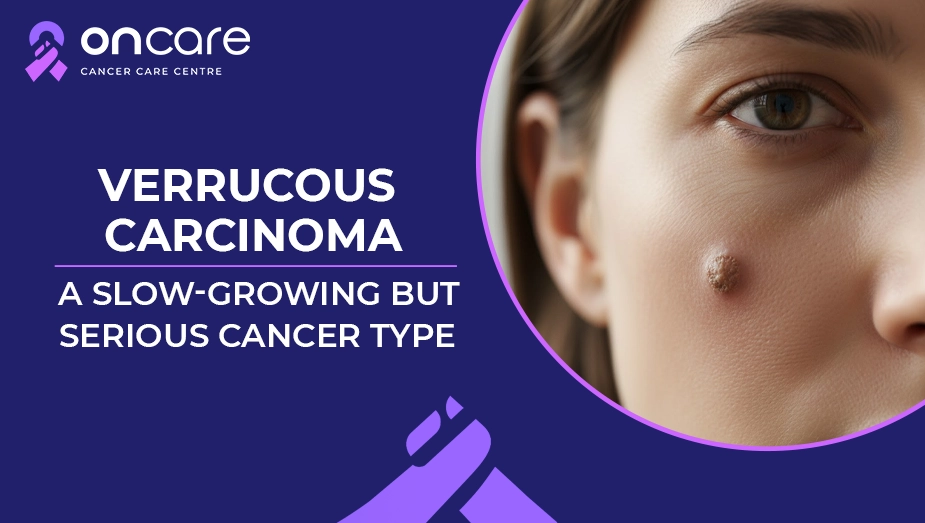 What is Lobular Carcinoma In Situ (LCIS) and how it differs from breast ...