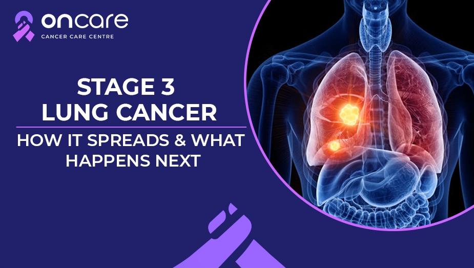 Stage 3 Colon Cancer Symptoms: Signs, Diagnosis, and Treatment Options