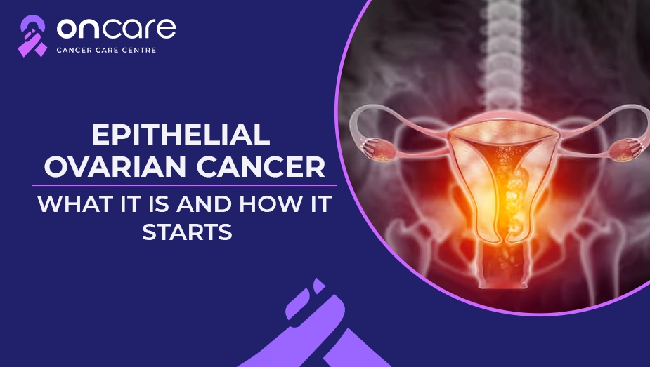 Why does early detection matters in stage 1 ovarian cancer?