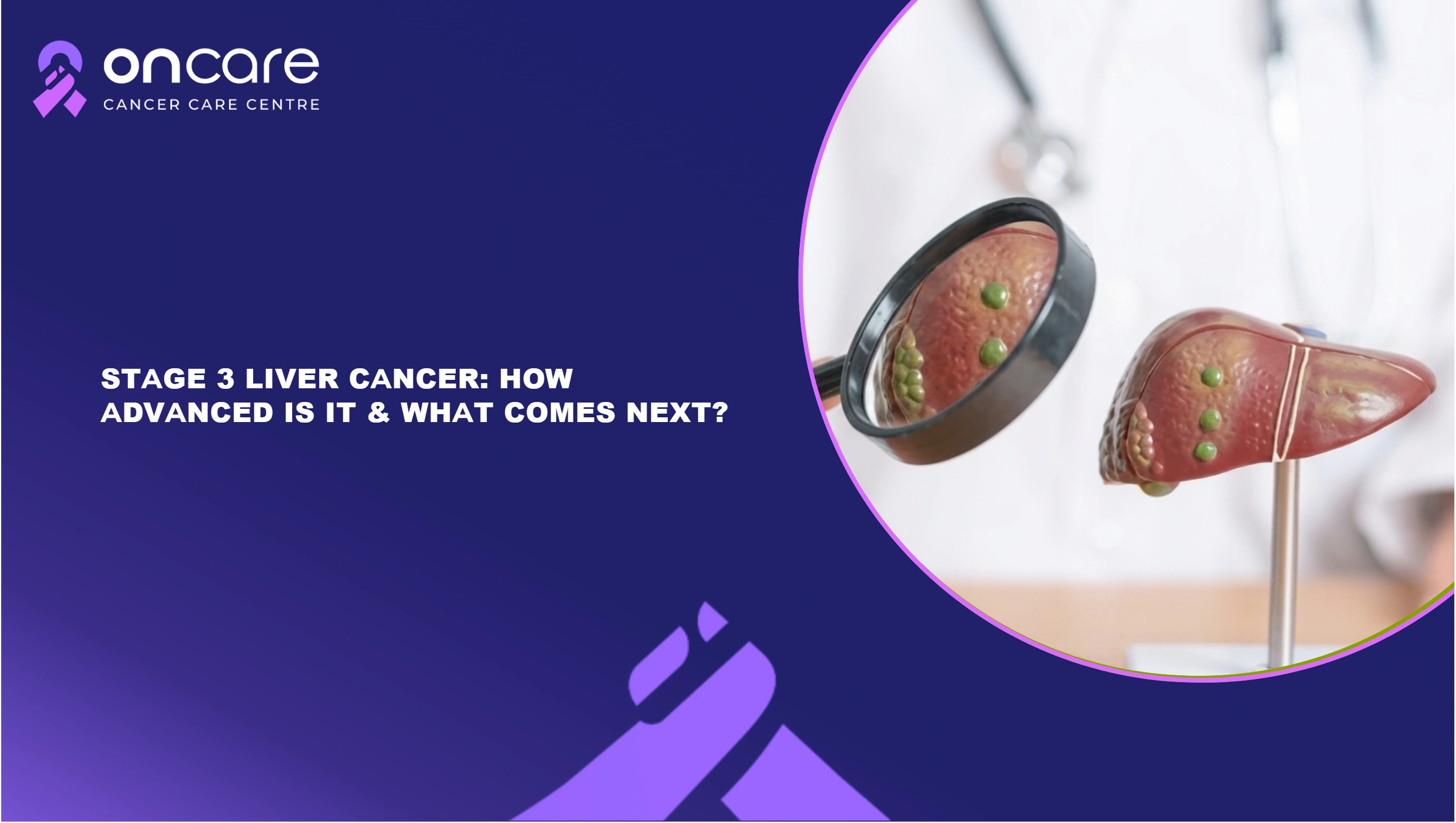 Stage 3 Colon Cancer Survival Rate & Treatment | Oncare